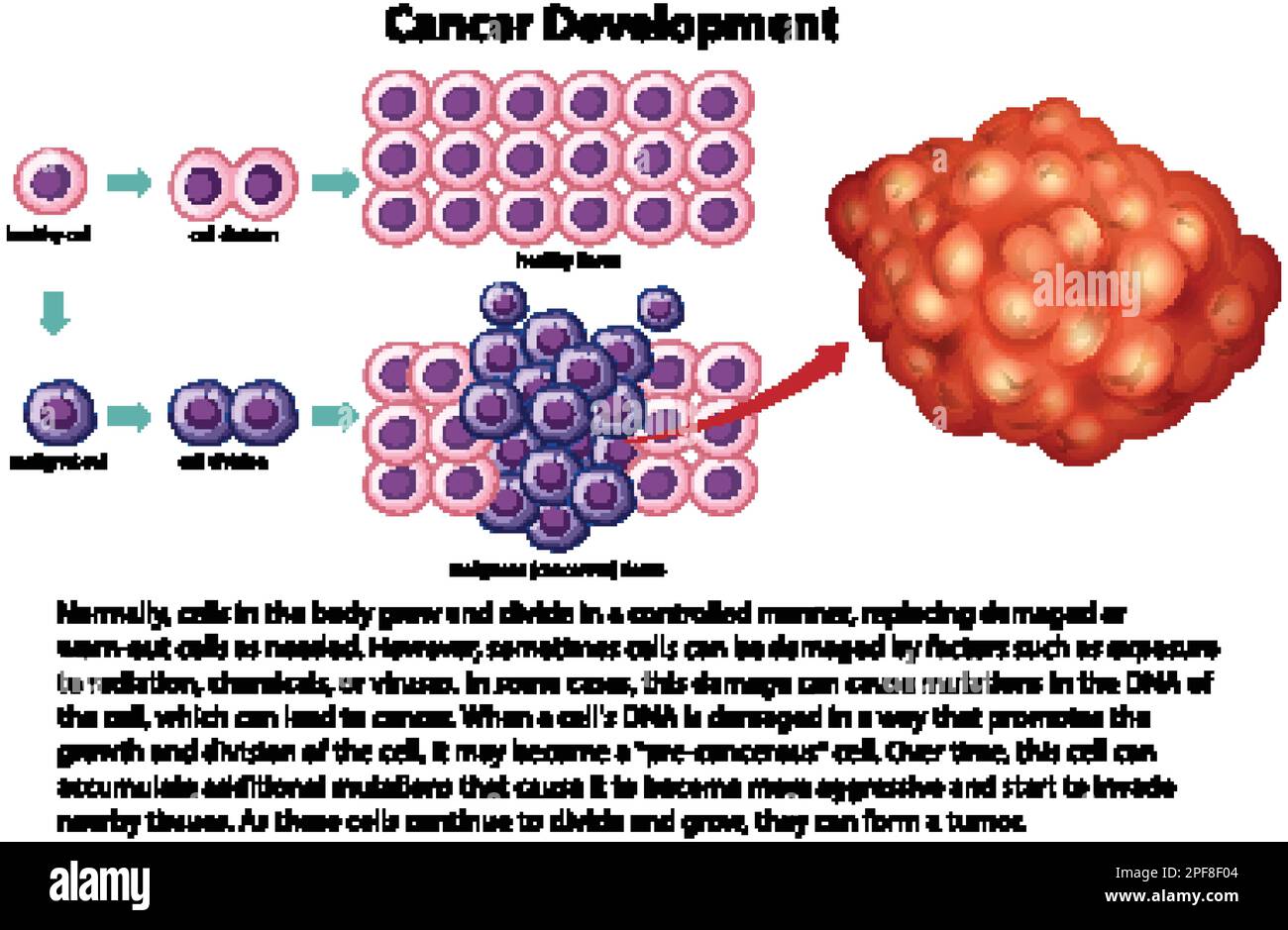 Cancerous vector vectors hi-res stock photography and images - Alamy