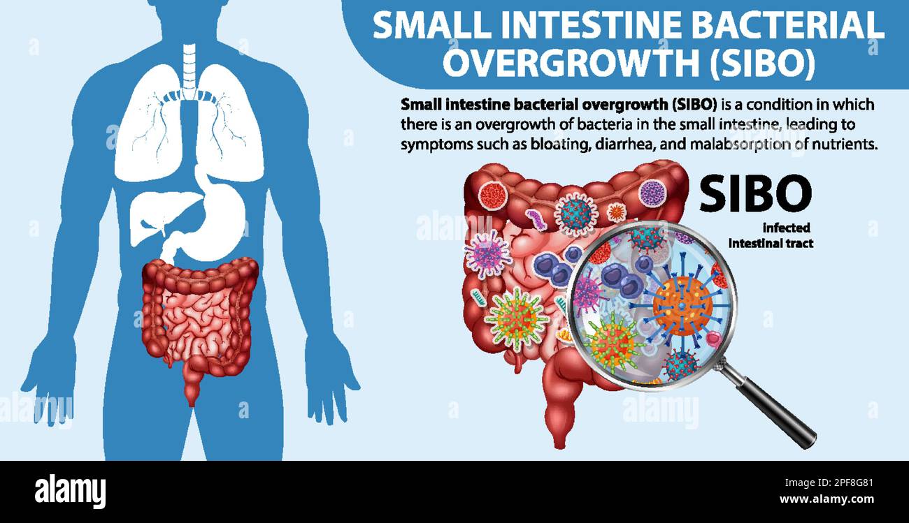Small intestine bacterial overgrowth hi-res stock photography and ...