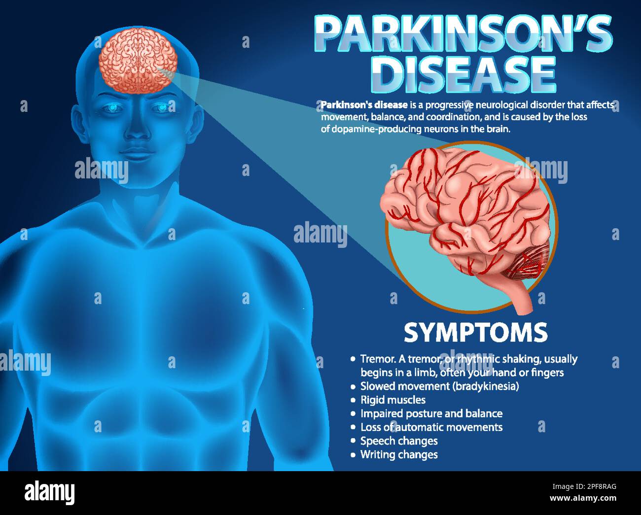 Informative poster of Parkinson disease illustration Stock Vector Image ...
