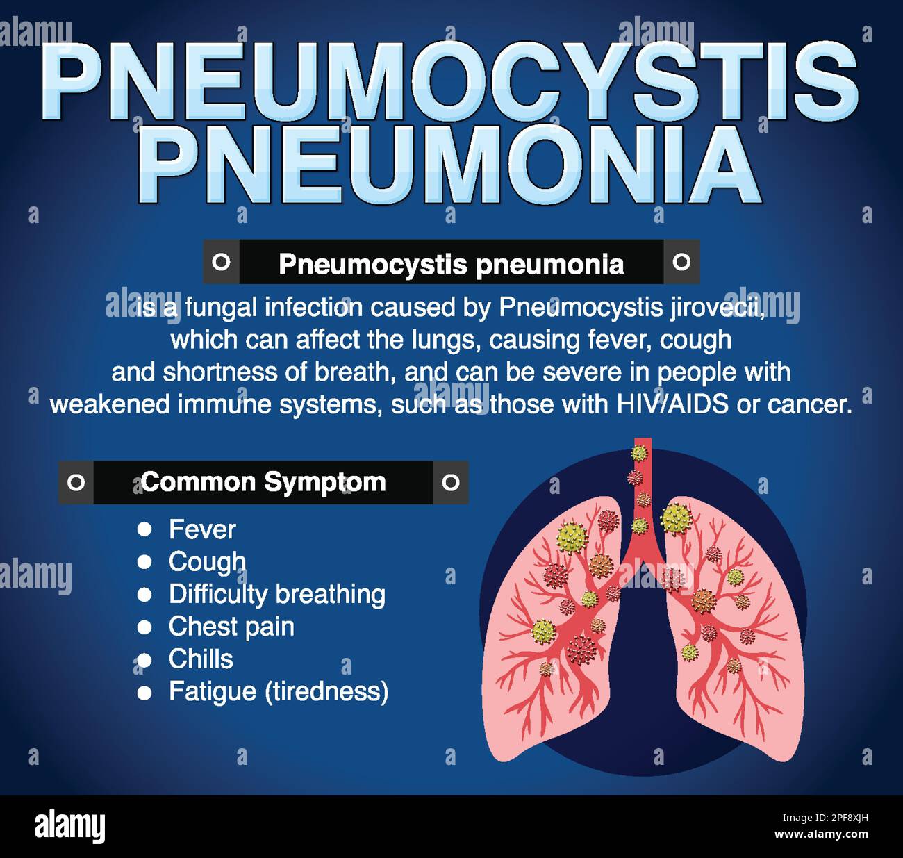 Informative poster of Pneumocystis Pneumonia illustration Stock Vector ...