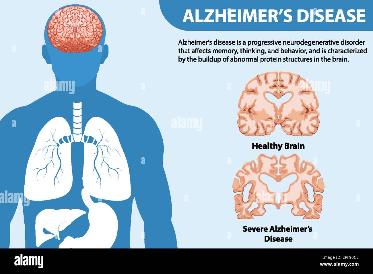 Informative poster of Alzheimers disease illustration Stock Vector ...