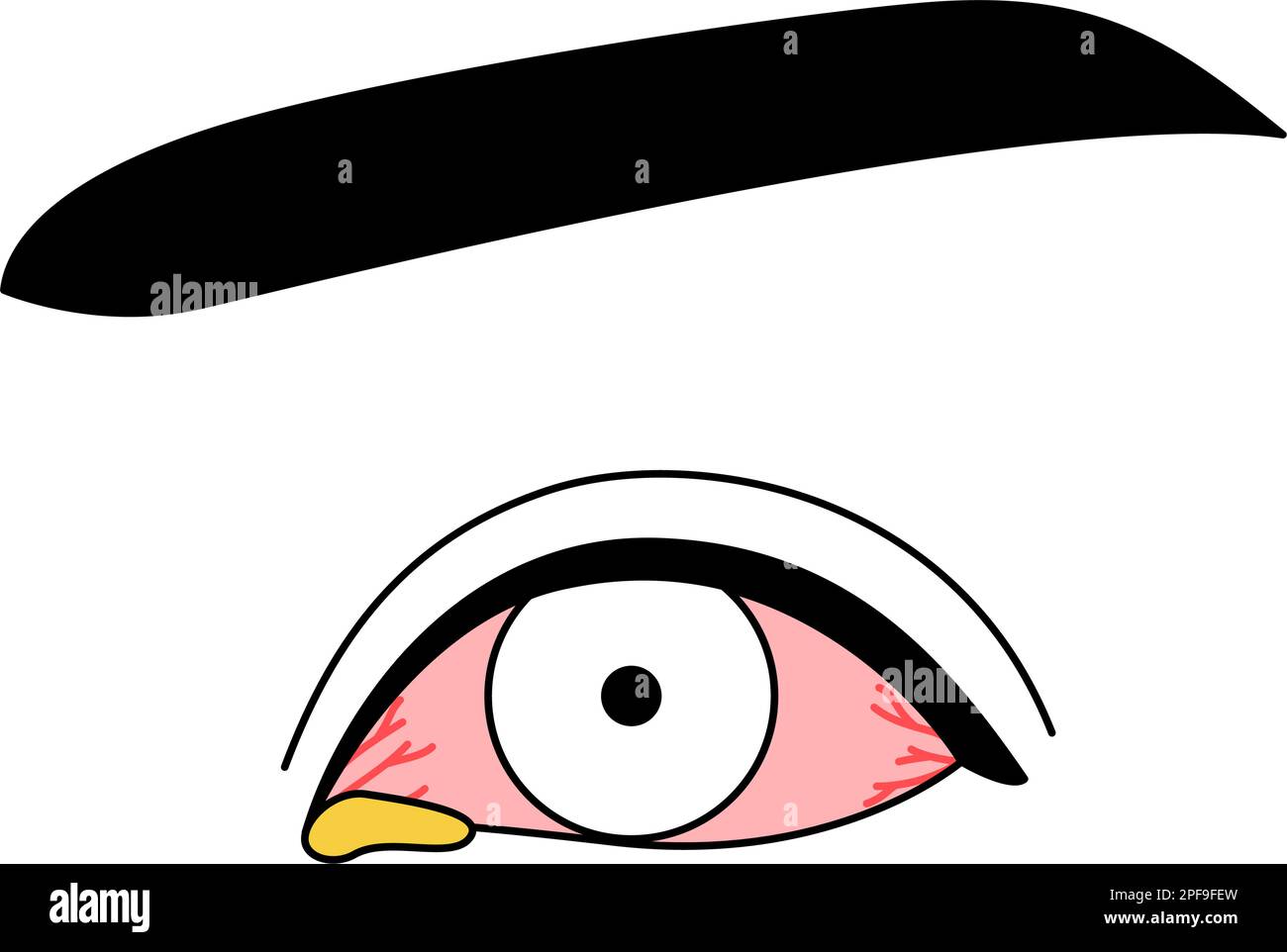 Medical Clipart, Line Drawing Illustration of Eye Disease and Bacterial ...