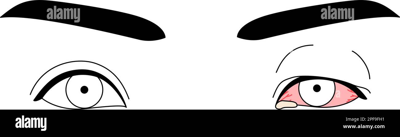 Medical Clipart, Line Drawing Illustration of Eye Disease and Viral ...