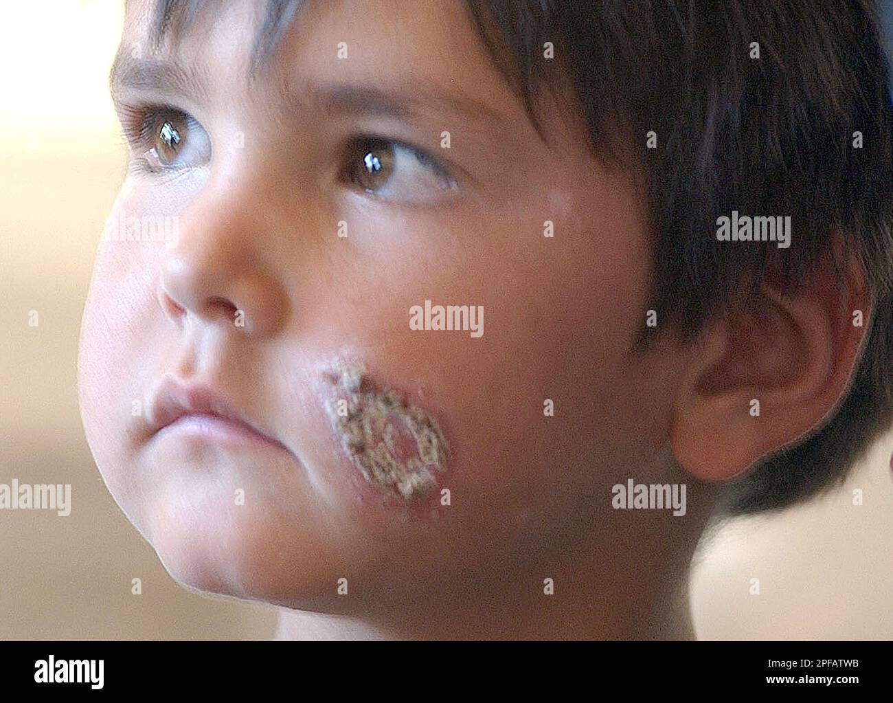 Ansar Deldar, 4-year-old, has a rash on face effected by Leishmaniasis ...