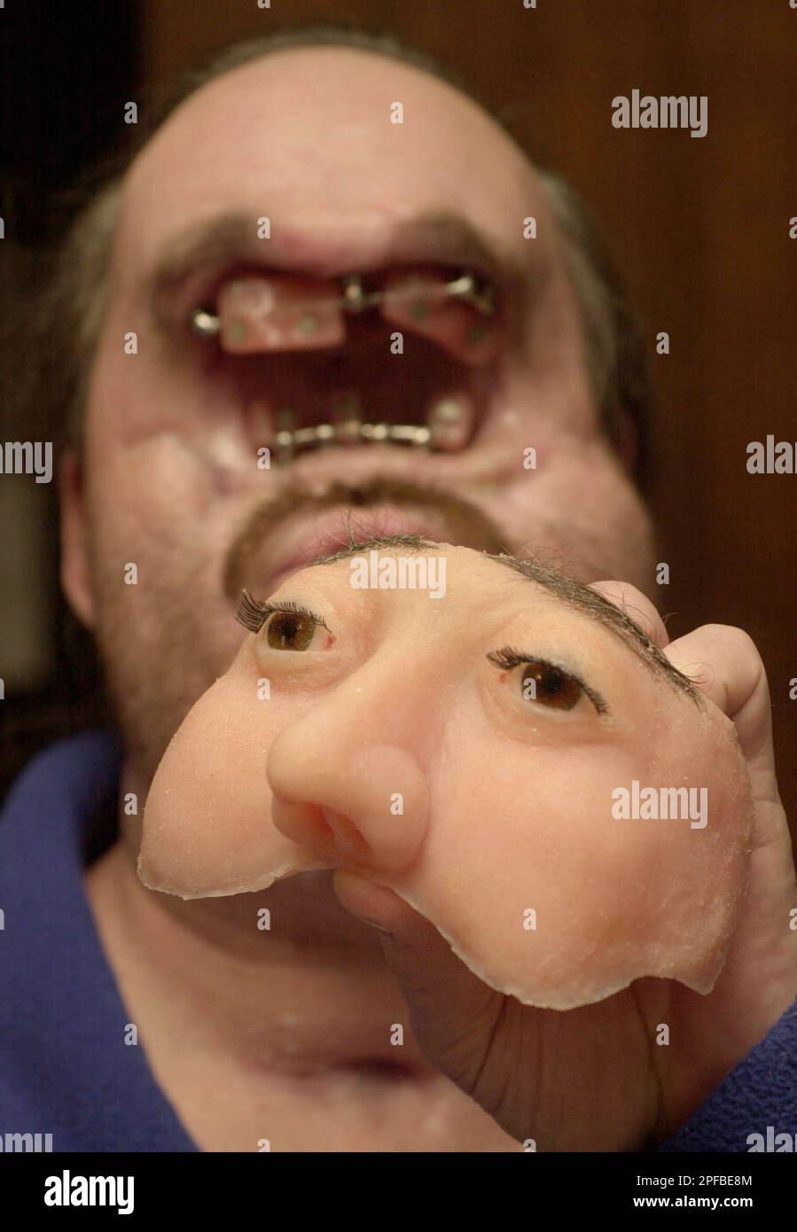 Mark Tatum whose bout with mucormycosis left a cavity in his face holds out his prosthetic face Feb. 5 2002 at his home in Maceo Ky. The eyes match his original eye