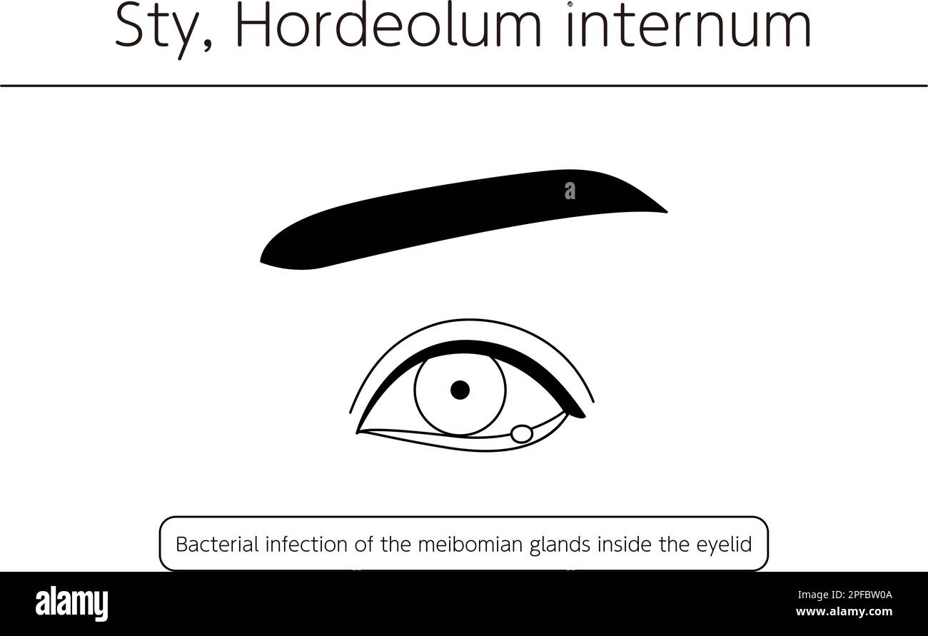 Medical Clipart, Line Drawing Illustration of Eye Disease and Sty ...