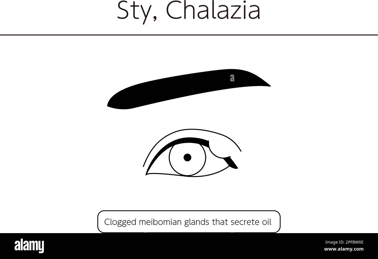 Mononucleosis vector vectors Cut Out Stock Images & Pictures - Alamy