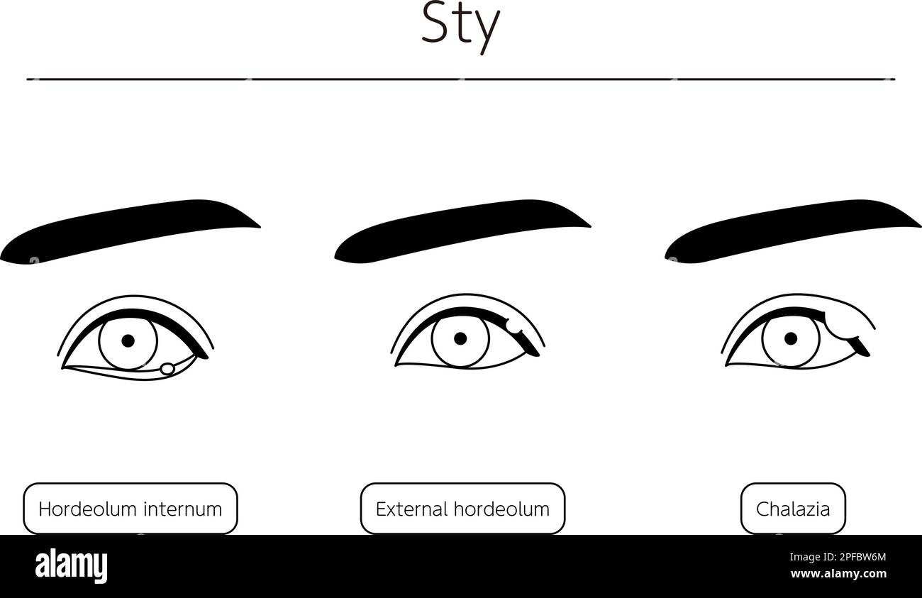 Medical Clipart, Line Drawing Illustration of Eye Disease and Sty ...