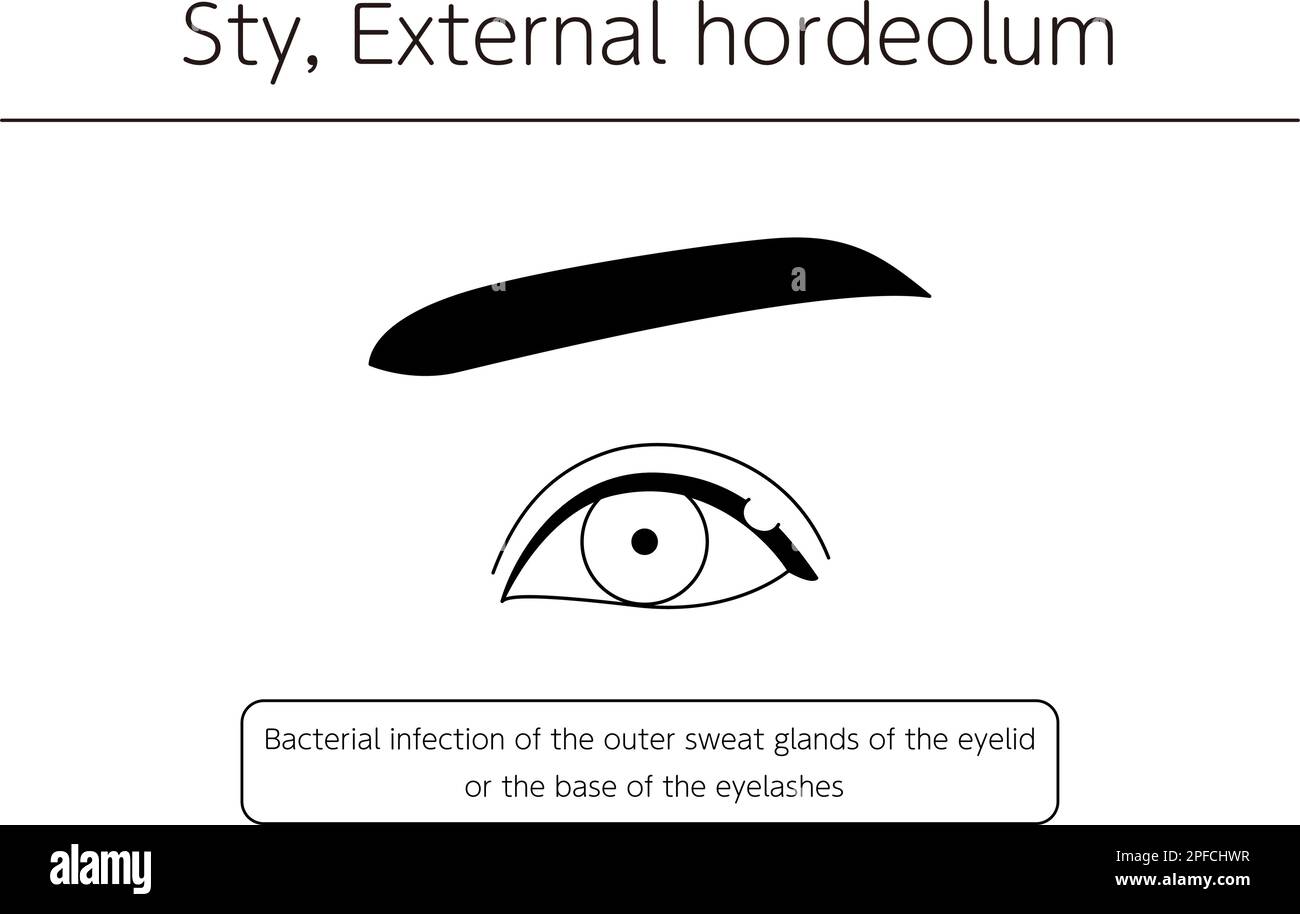 Foreign body granuloma Stock Vector Images - Alamy