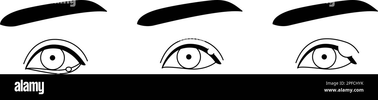 Medical Clipart, Line Drawing Illustration of Eye Disease and Sty ...