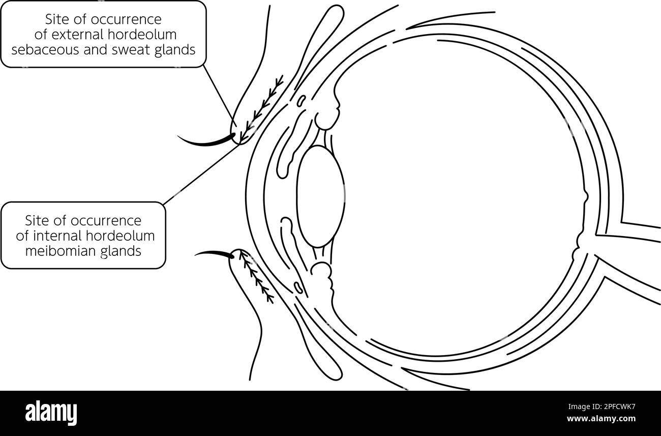 Medical illustration, Anatomical drawing of the site of origin of eye ...