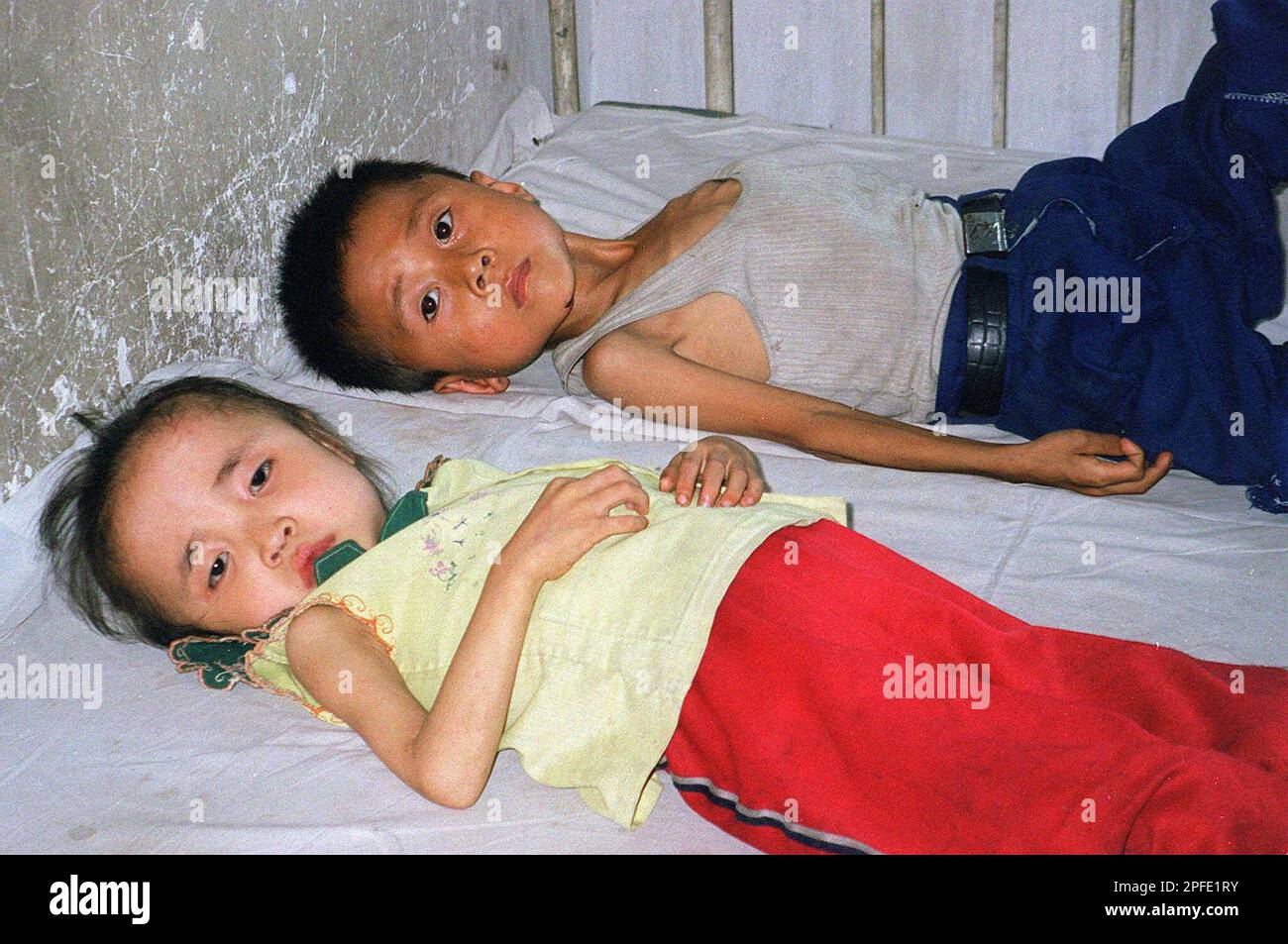 Two young children suffering from malnutrition rest in a a bed at the ...