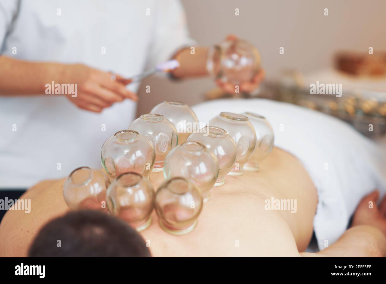 Cupping therapy chinese traditional hi-res stock photography and images ...