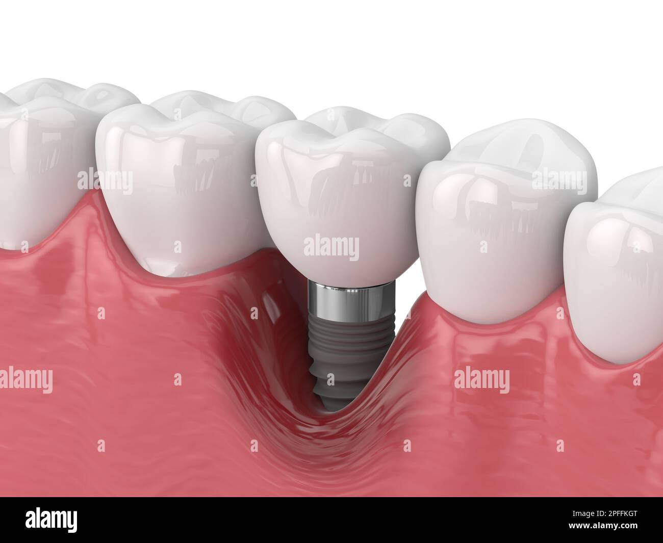 Peri implant mucositis hi-res stock photography and images - Alamy