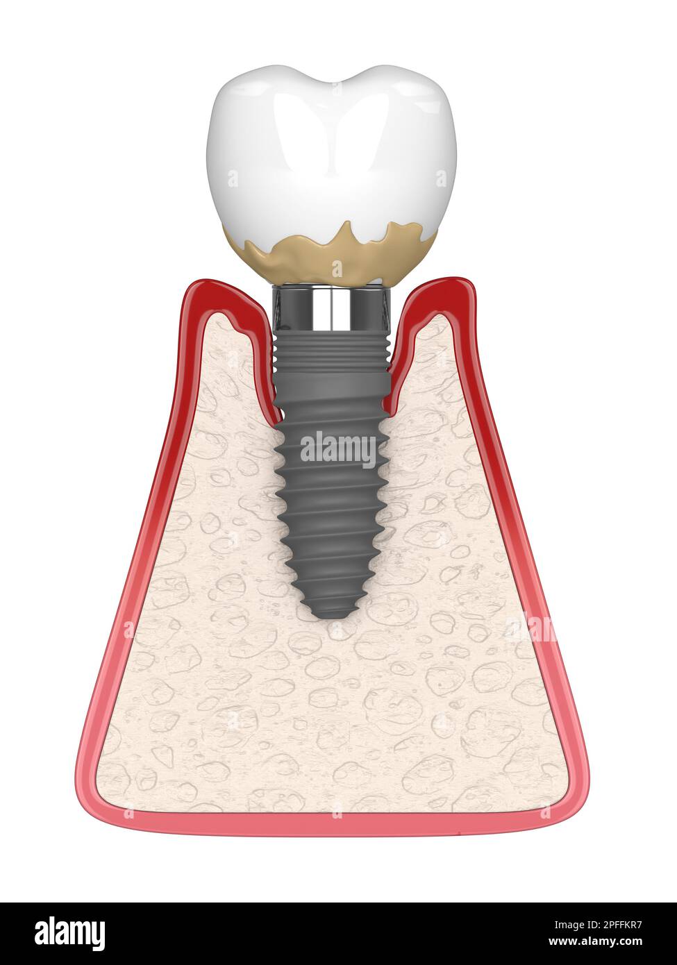 3d render of human gums cross-section with peri implantitis disease ...