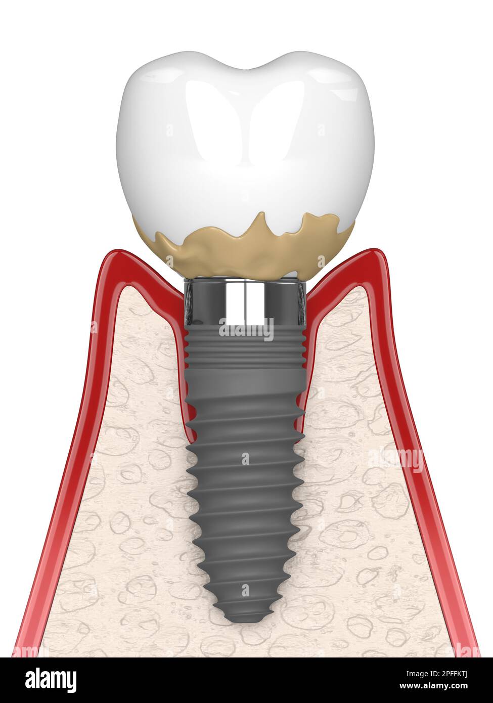 3d render of human gums cross-section with peri implantitis disease ...