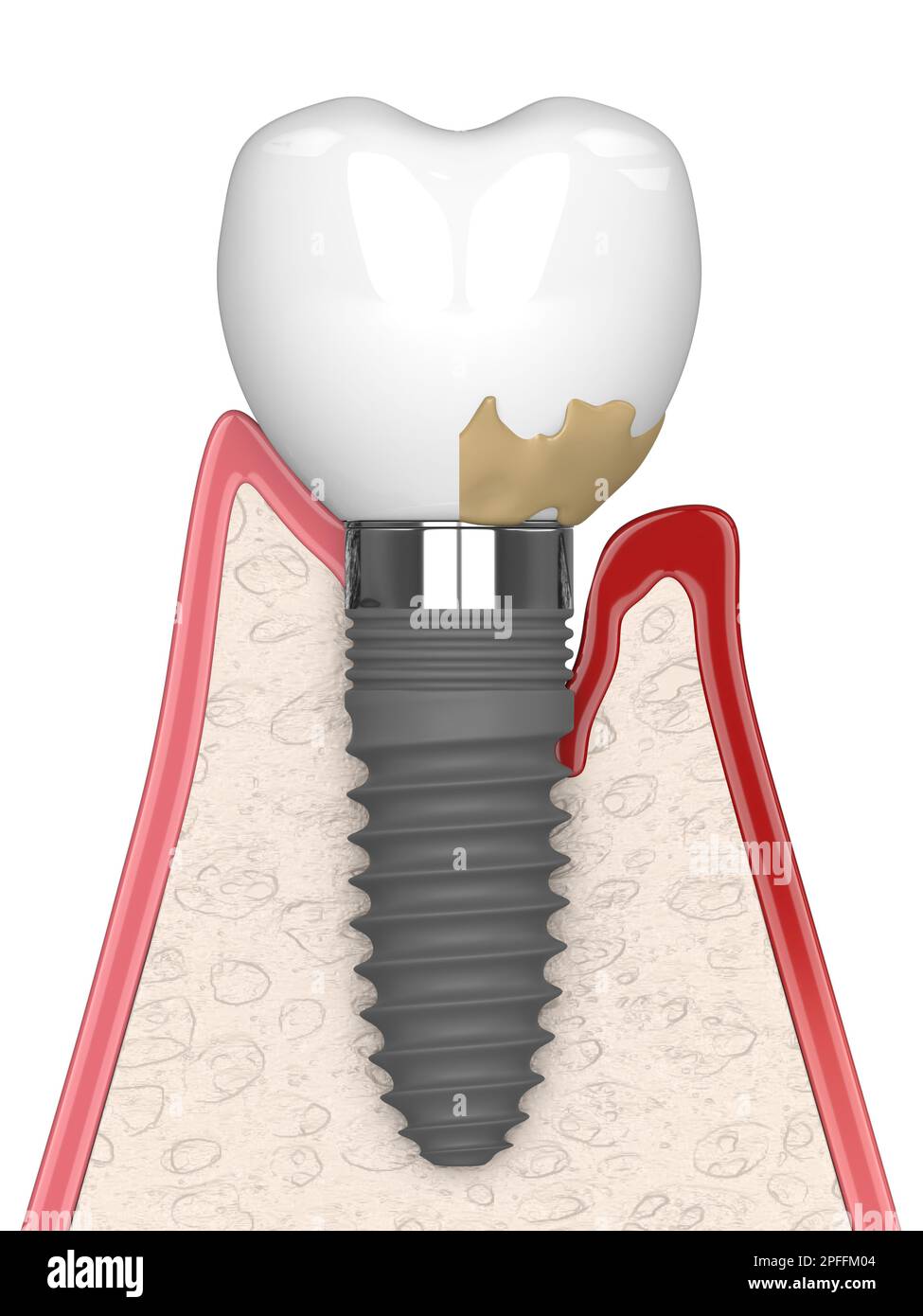 3d render of healthy implant versus implant with peri implantitis over ...