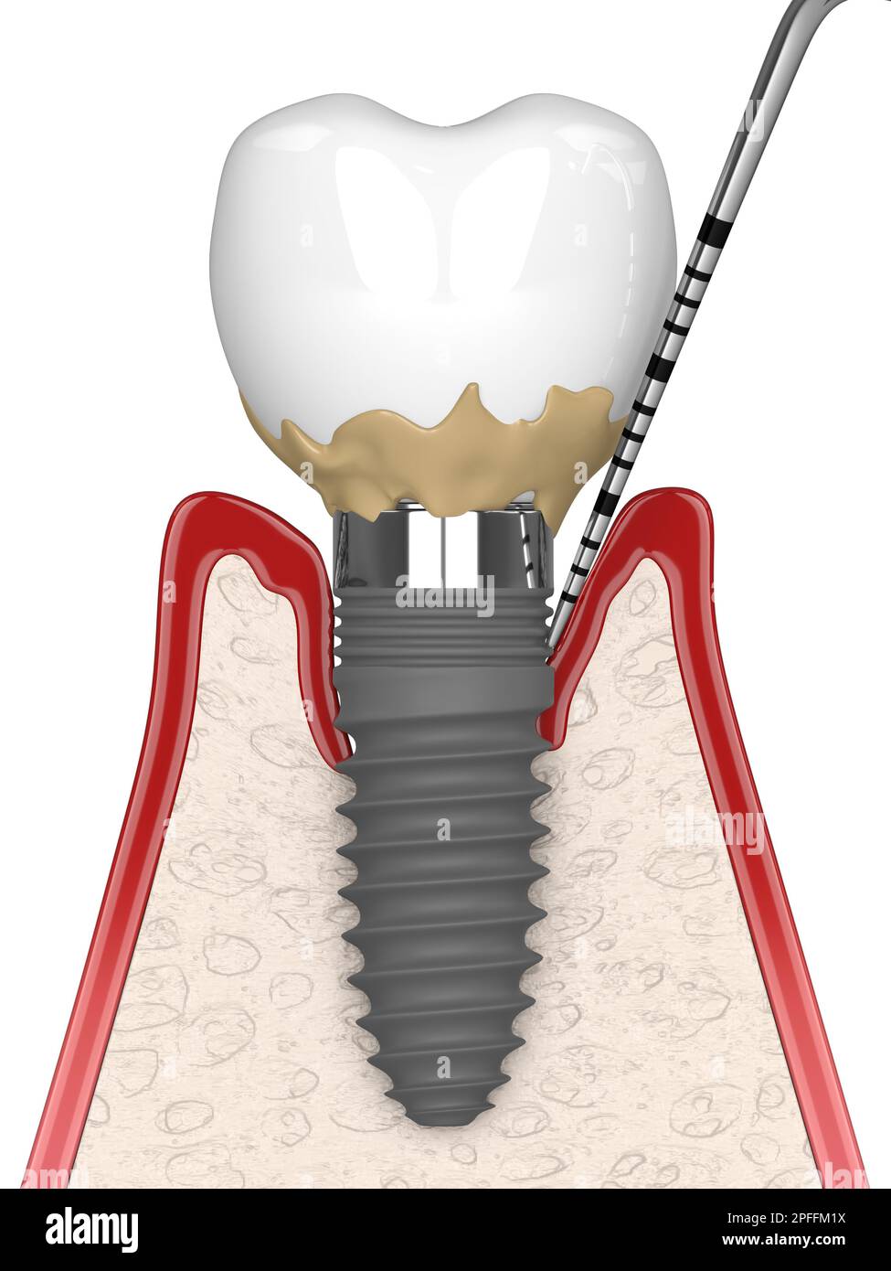 3d render of human gums cross-section with peri implantitis disease and ...