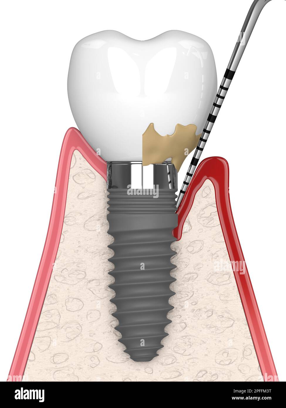3d render of healthy implant versus implant with peri implantitis over ...