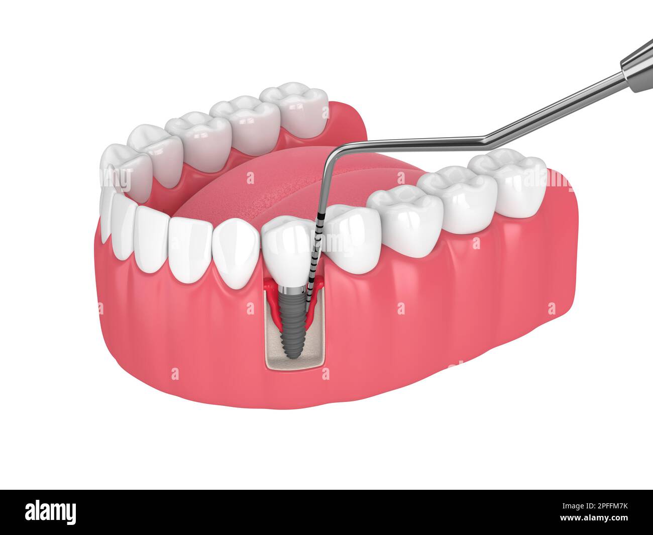 3d render of human jaw with peri implantitis disease and periodontal ...