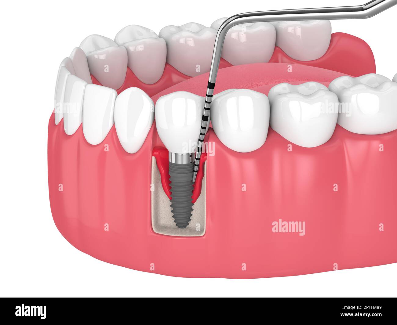 3d render of human jaw with peri implantitis disease and periodontal ...