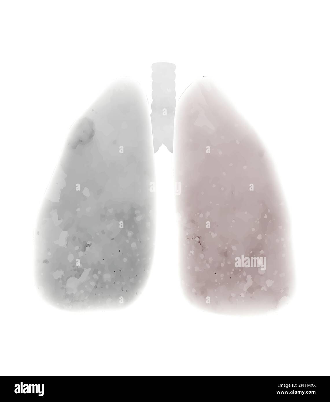Vector watercolor illustration of diseased lungs. Smoky respiratory ...