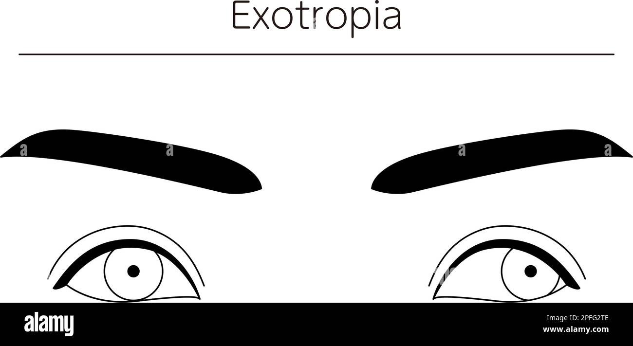 Medical illustrations, diagrammatic line drawings of eye diseases ...