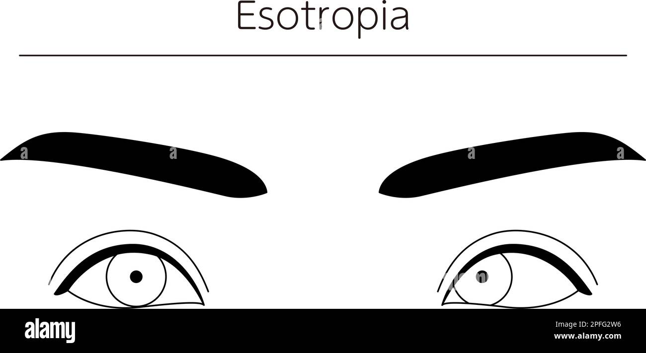 Medical illustrations, diagrammatic line drawings of eye diseases ...