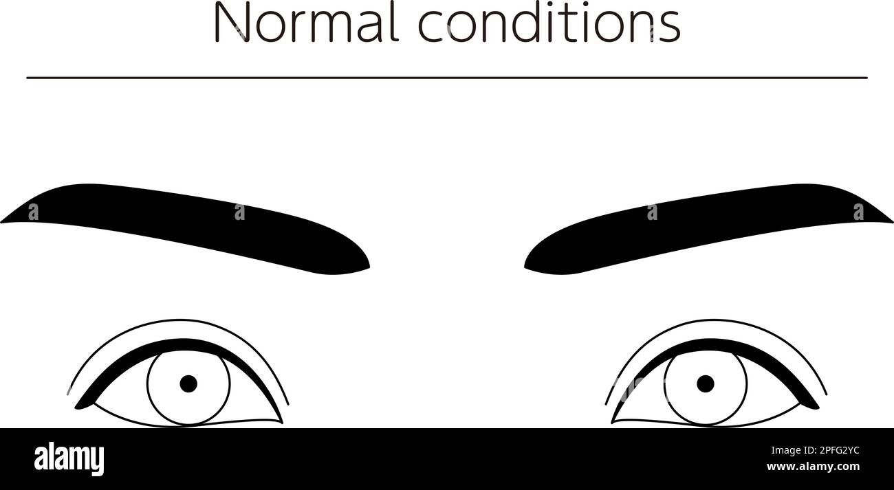 Medical illustrations, diagrammatic line drawings of eye diseases ...