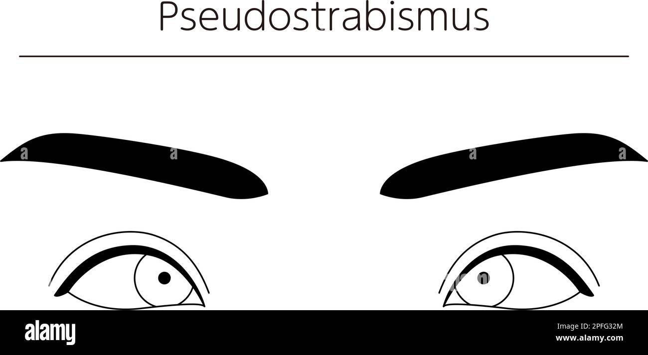 Medical illustrations, diagrammatic line drawings of eye diseases ...