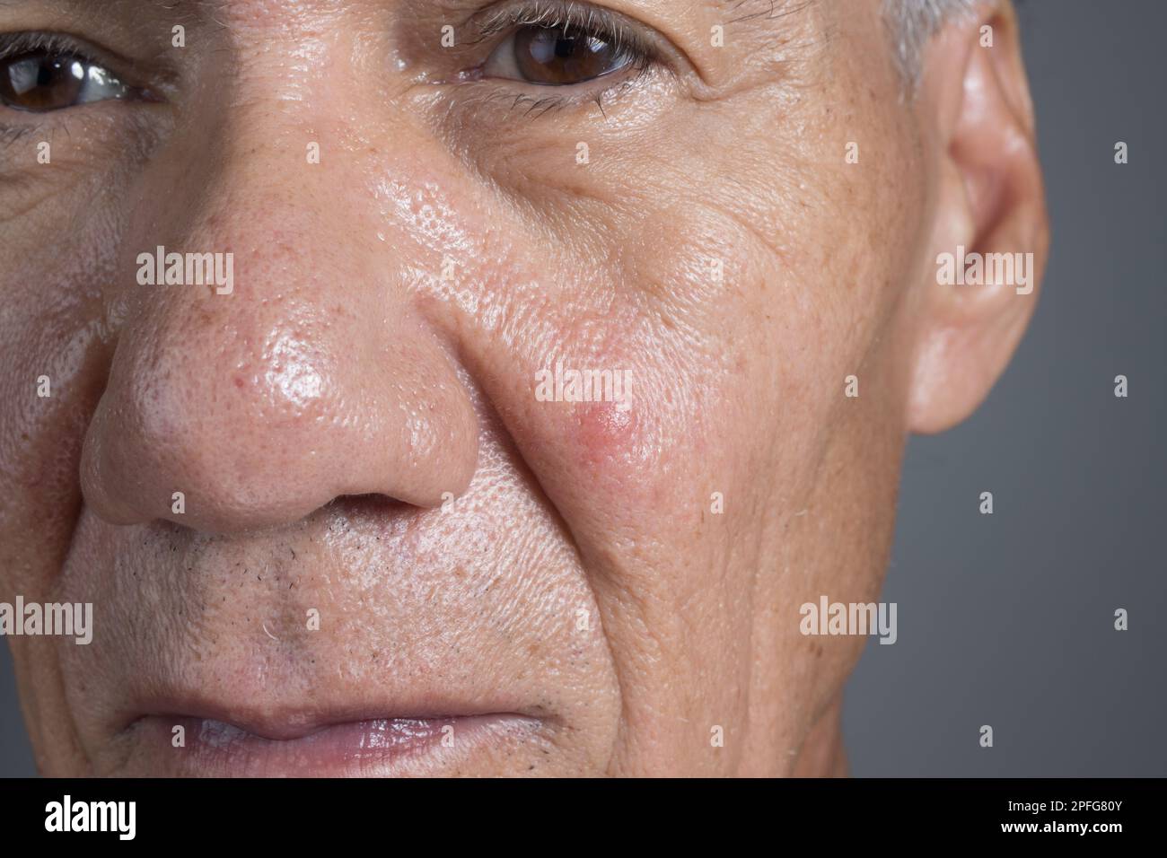 Close up of a Man with a big ugly pimple on his cheek Stock Photo - Alamy