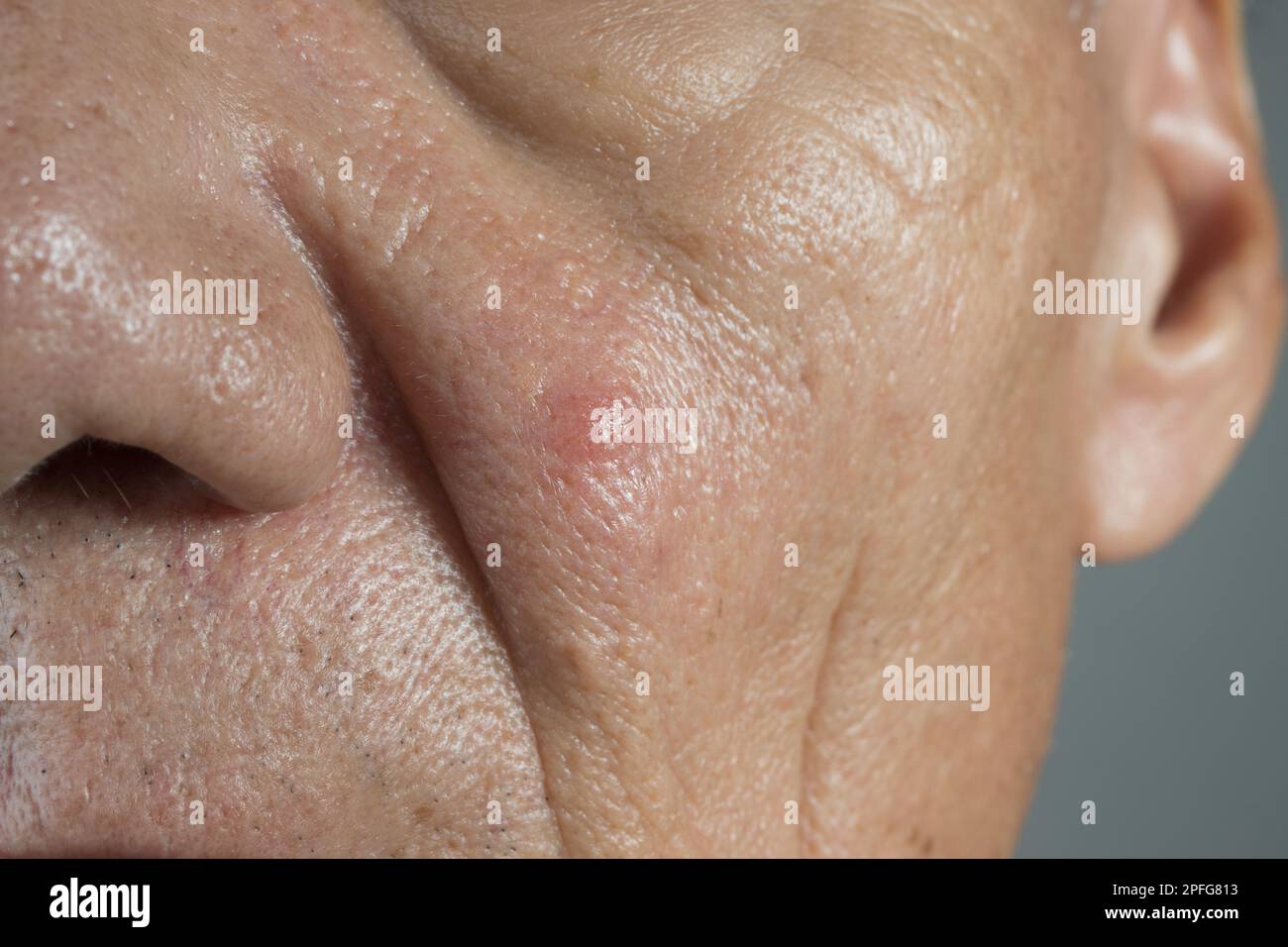 Close up of a Man with a big ugly pimple on his cheek Stock Photo - Alamy