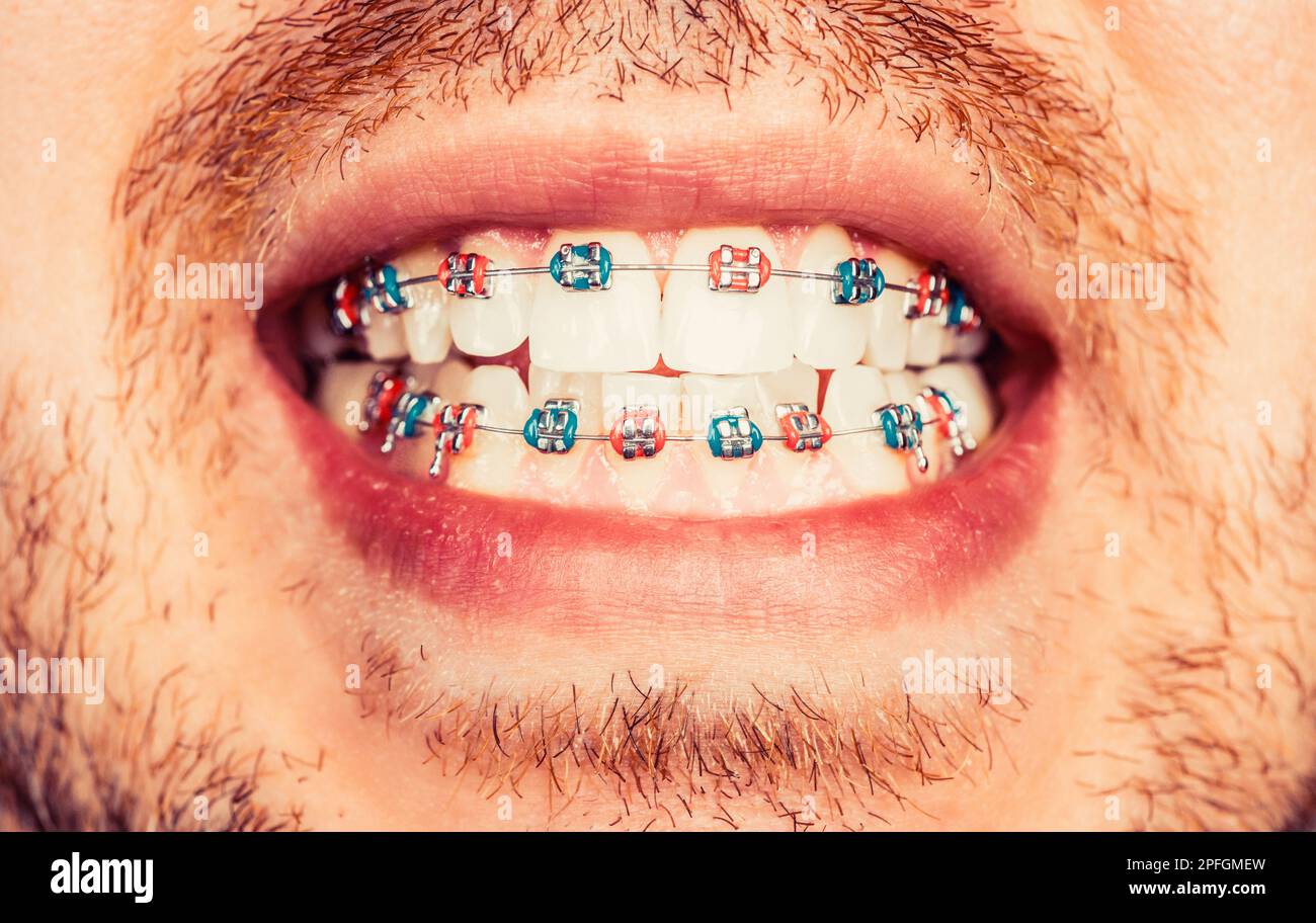 Dental concept. Man with braces. Bracket system in smiling mouth, macro ...