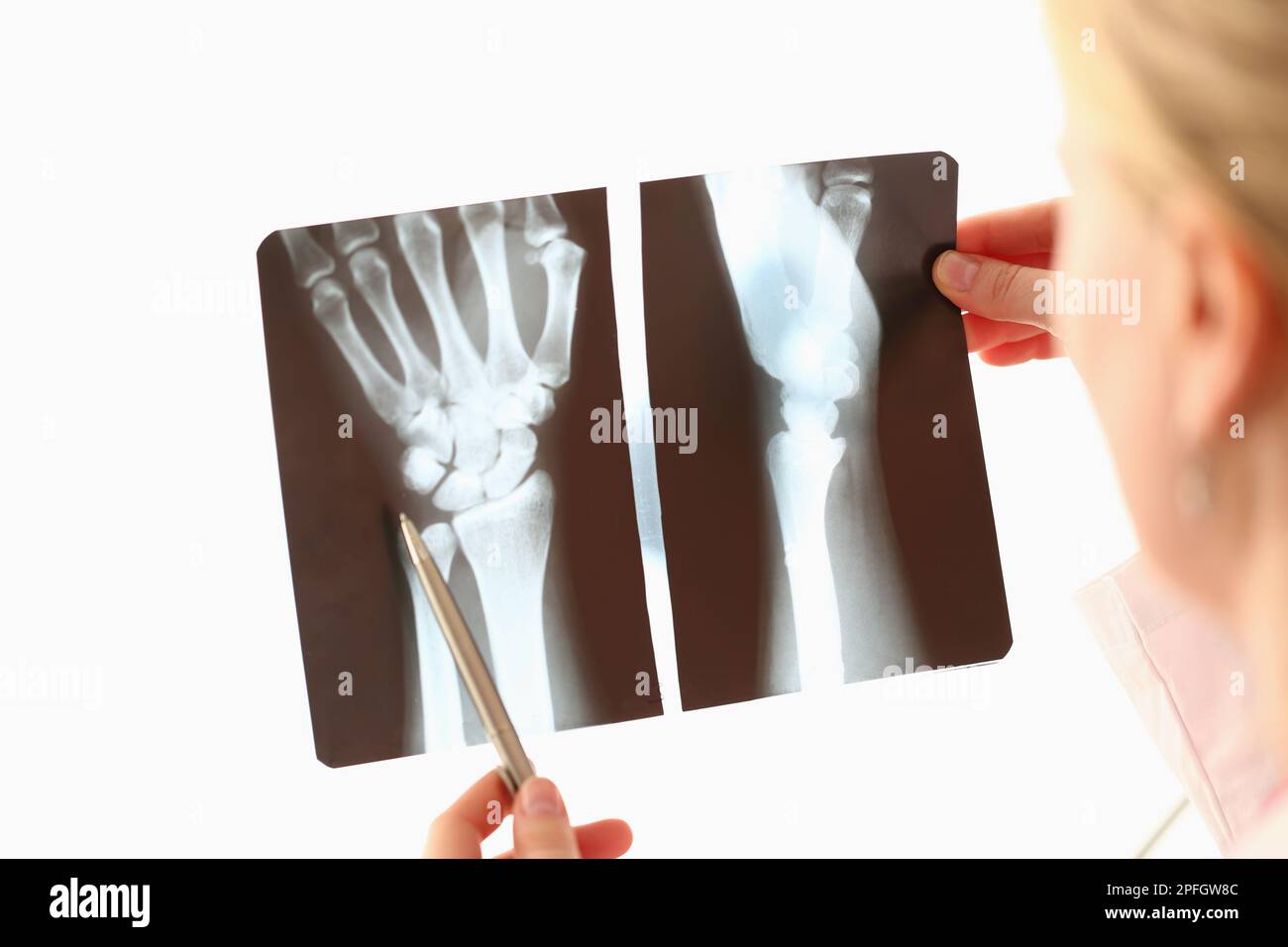 Rheumatoid arthritis hands x ray hi-res stock photography and images ...