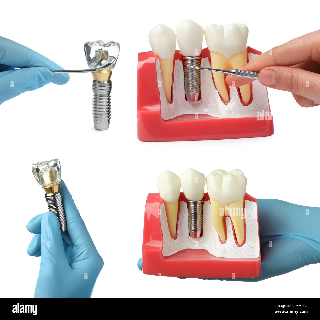 Dentists showing educational models of dental implants on white ...