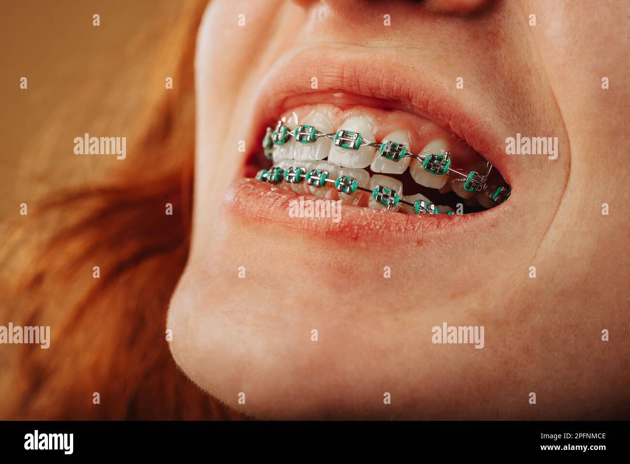 Close up of ginger girl showing her teeth with braces Stock Photo - Alamy