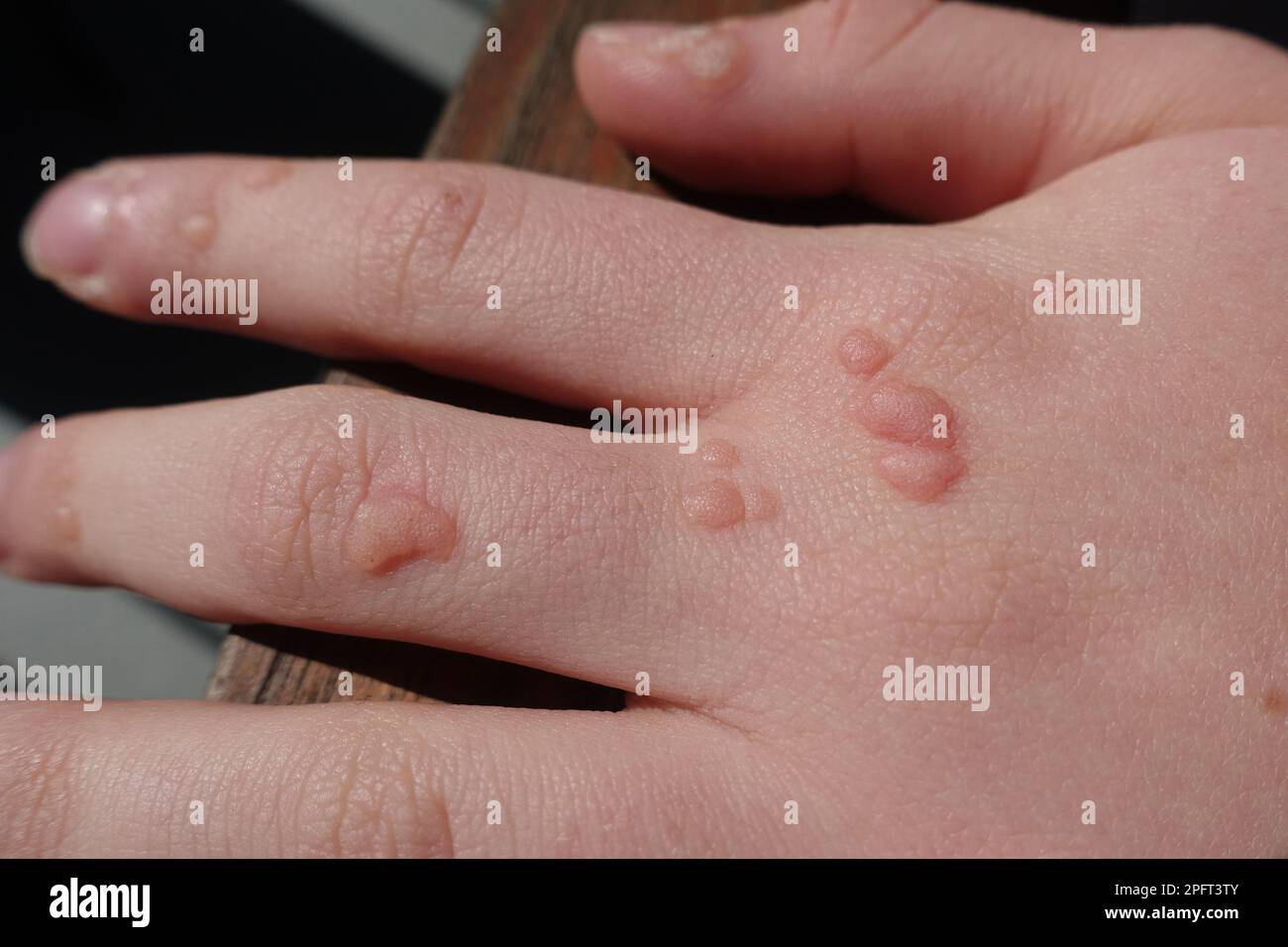 Raised bumps on hands hi-res stock photography and images - Alamy