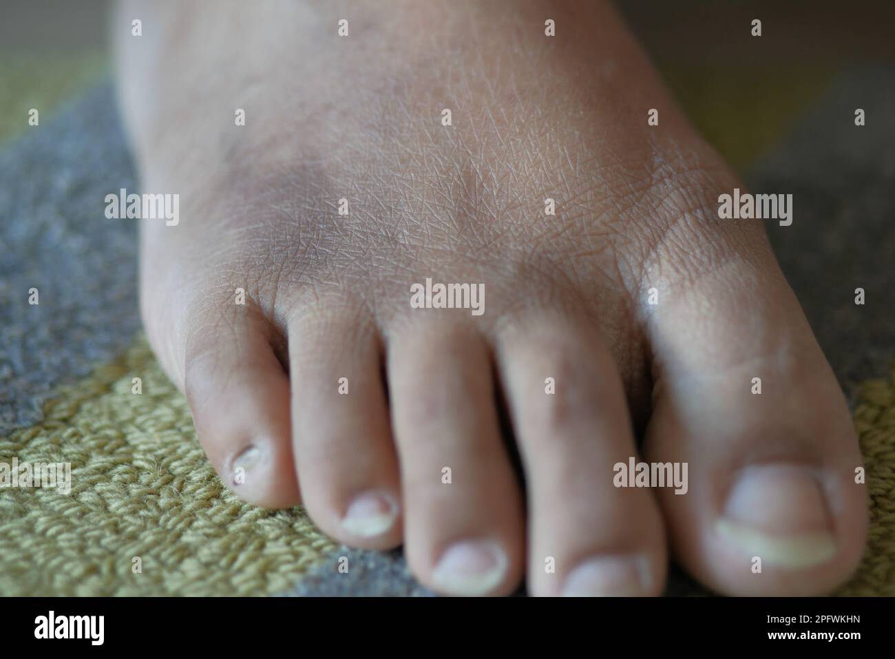 close up of women feet with swelling Stock Photo - Alamy
