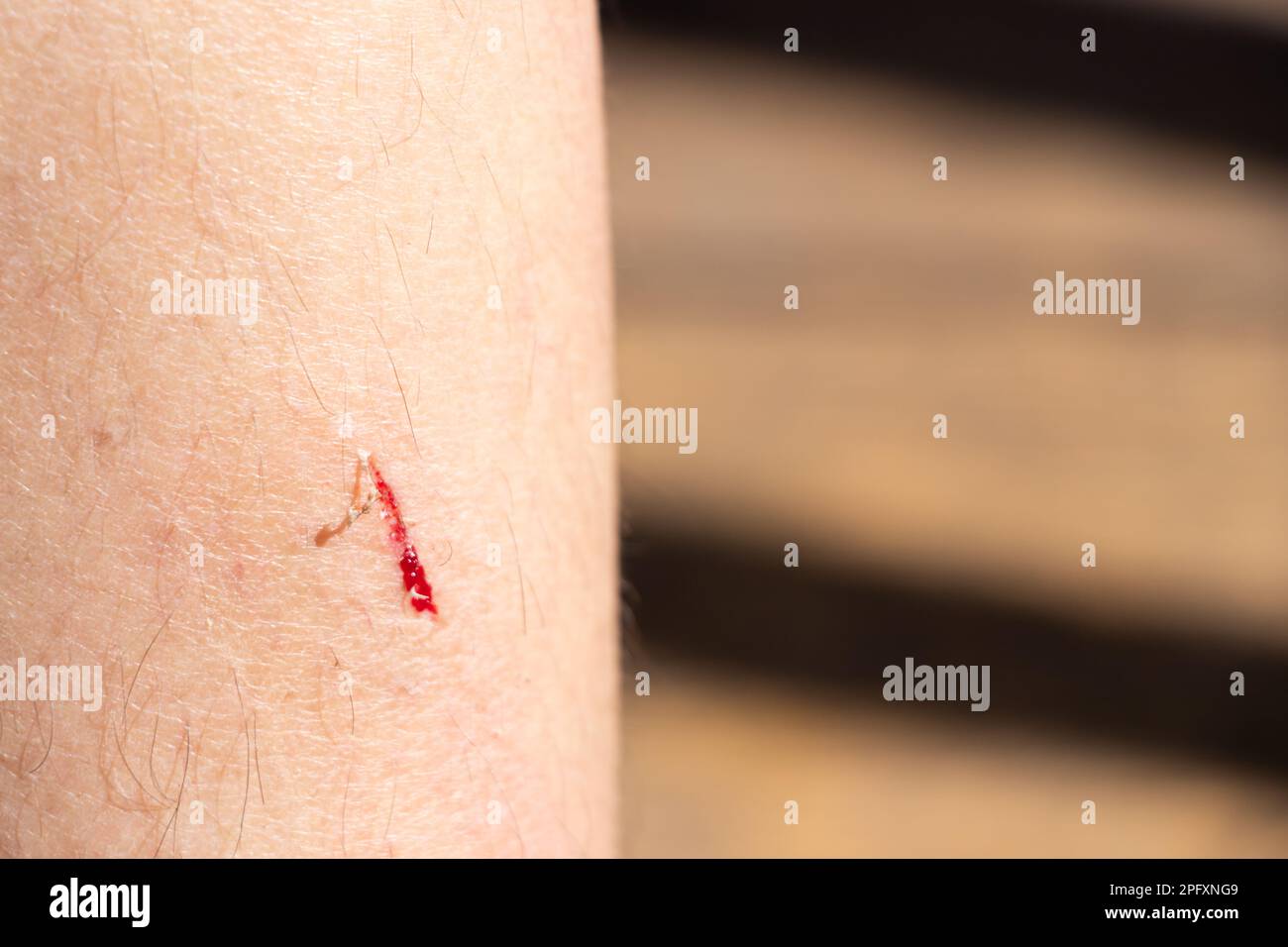 Bruised wound injury with blood bleeding on woman leg background Stock ...