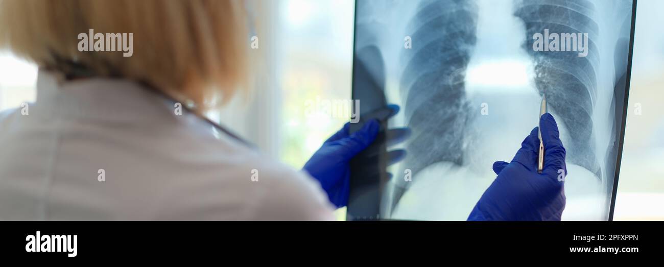 Doctor pointing at damaged area on lung x ray Stock Photo - Alamy