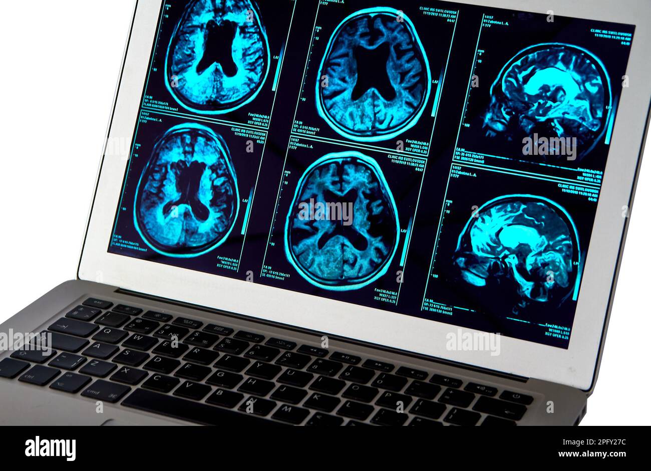 Magnetic resonance imaging of the human brain in close-up on a computer ...