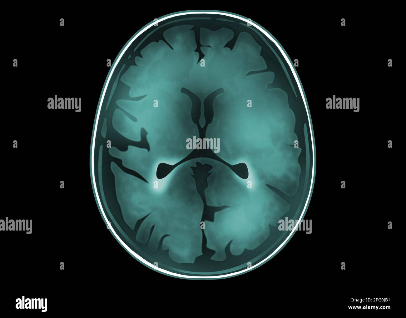 Scan of human brain on black background, illustration Stock Photo - Alamy