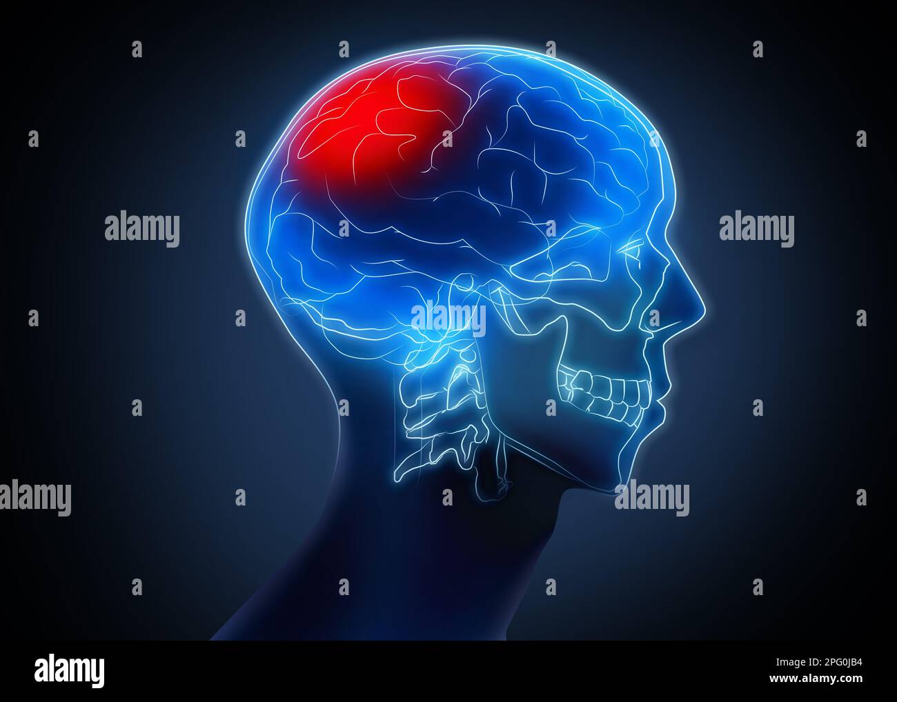 Scan of human brain with injured area on dark background, illustration ...