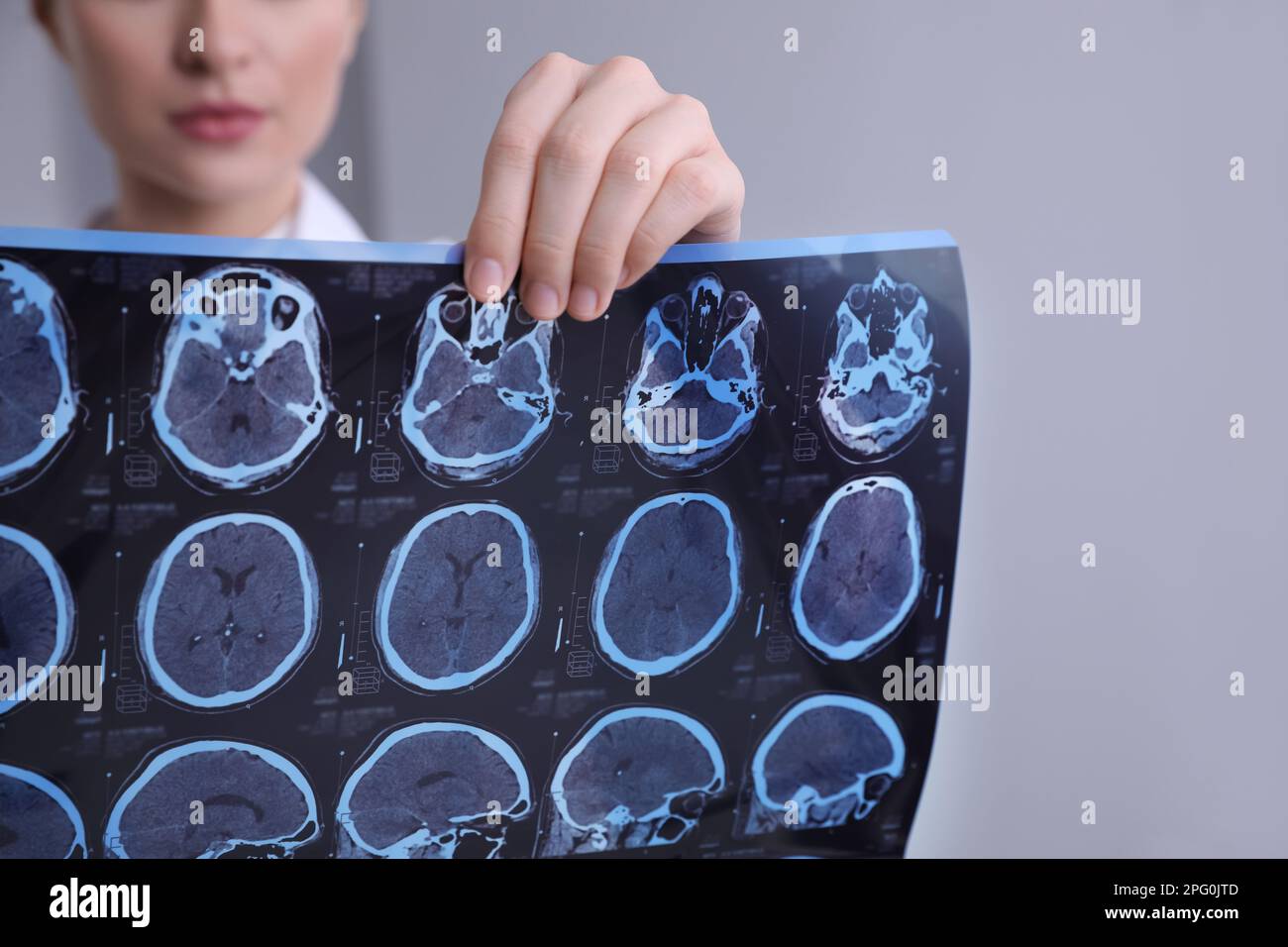 Doctor examining MRI images of patient with multiple sclerosis in ...