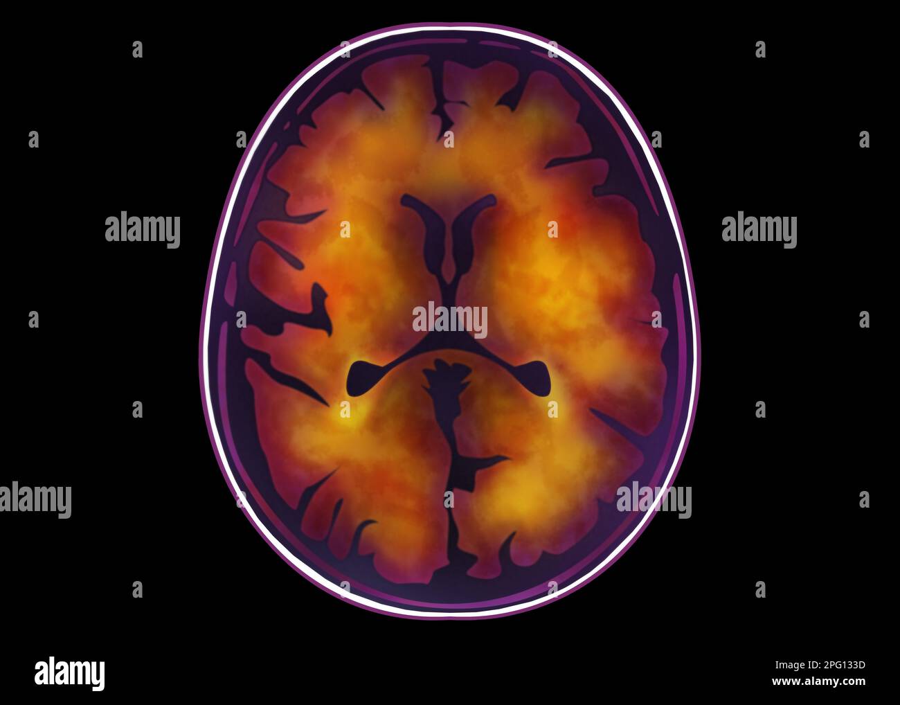 Scan of injured human brain with injured area on black background ...
