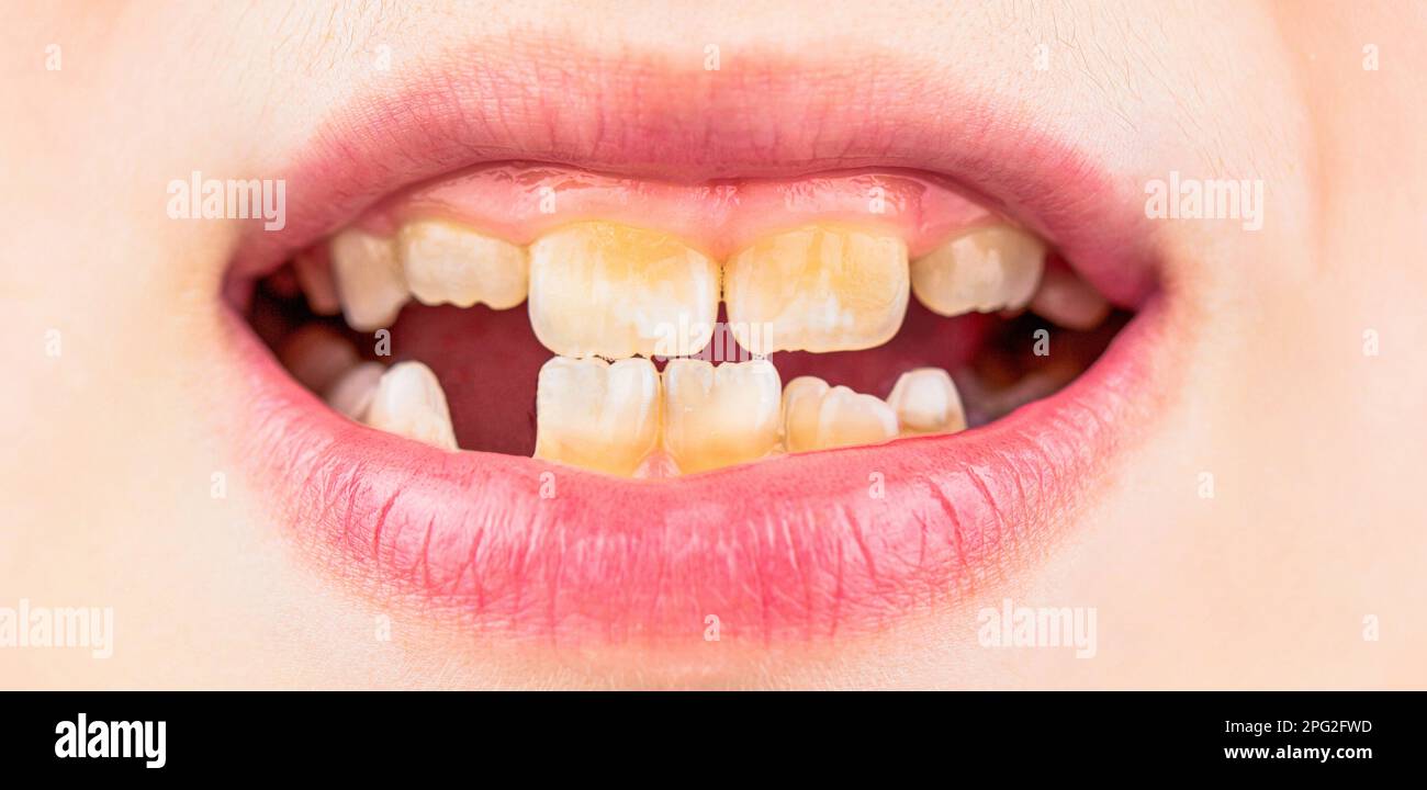 Kid patient open mouth showing cavities teeth decay. Child smile and ...