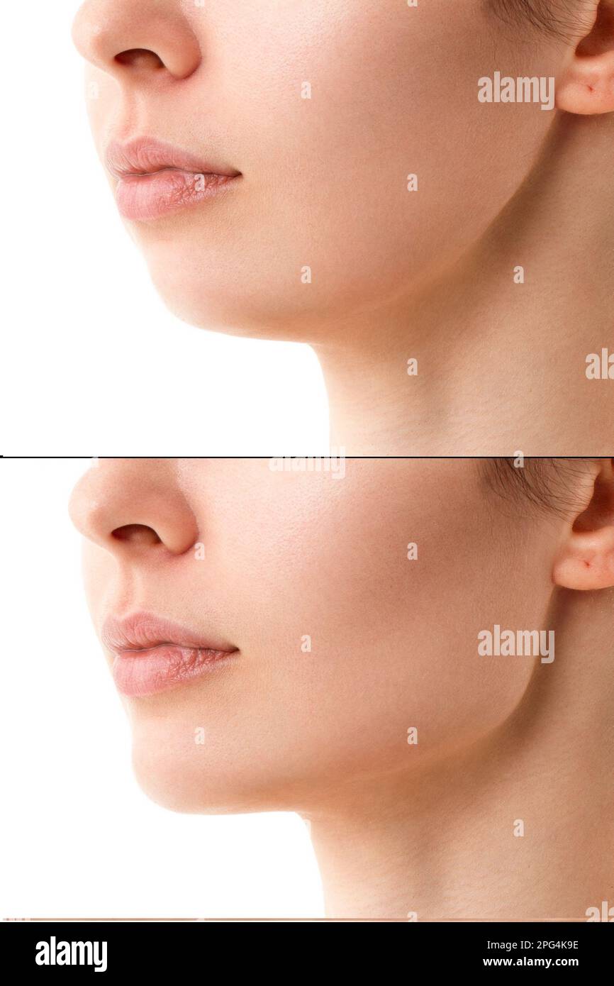 Close-up portrait of a woman before and after a chin correction ...