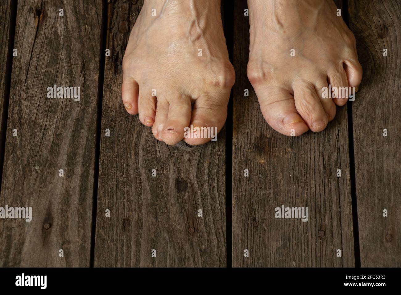 Varicose veins in legs hi-res stock photography and images - Alamy
