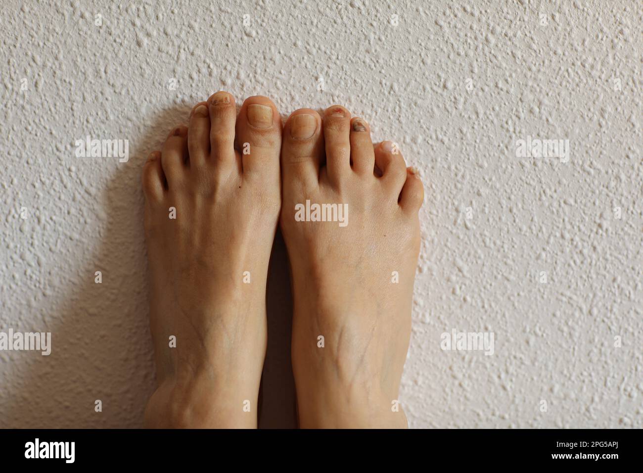 Female feet with subungual hematoma, black toenails caused by trauma ...