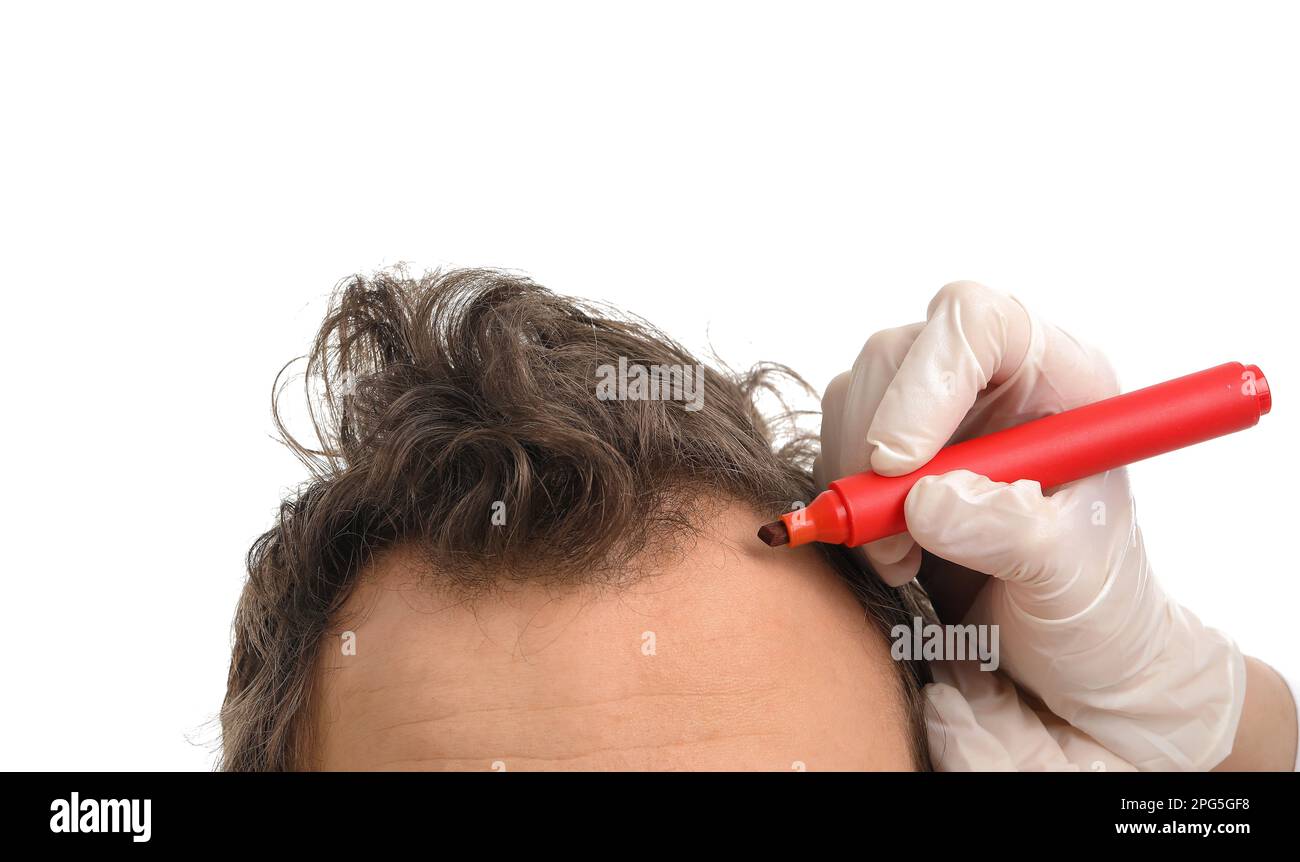 Doctor marking young man's forehead with hair loss problem on white ...